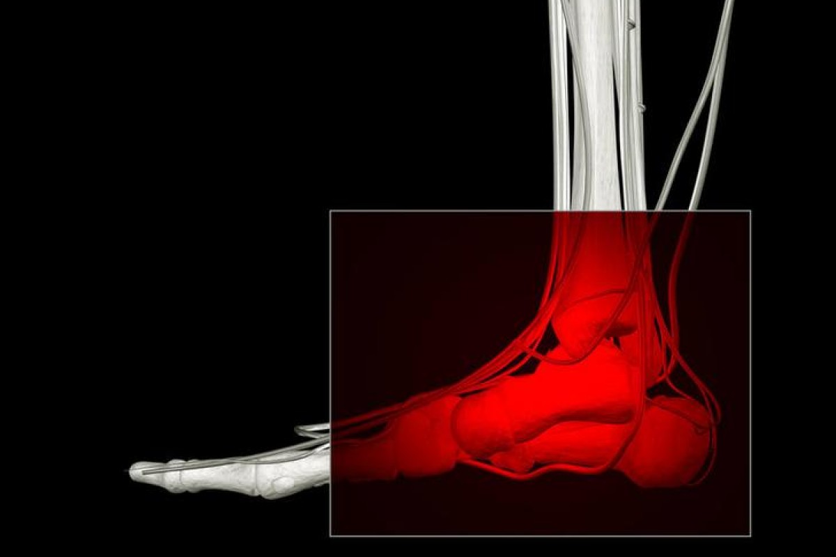 From the experts: high heels a key culprit in ankle sprains | South ...