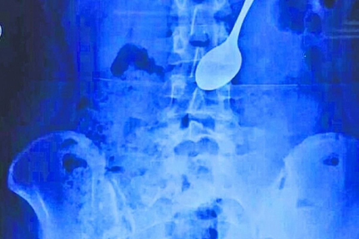 Chinese student hospitalised after swallowing metal spoon 'while eating ...