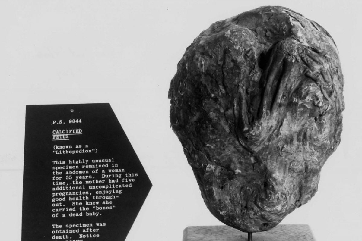 The ‘stone baby’: For more than 50 years, she carried her unborn child ...