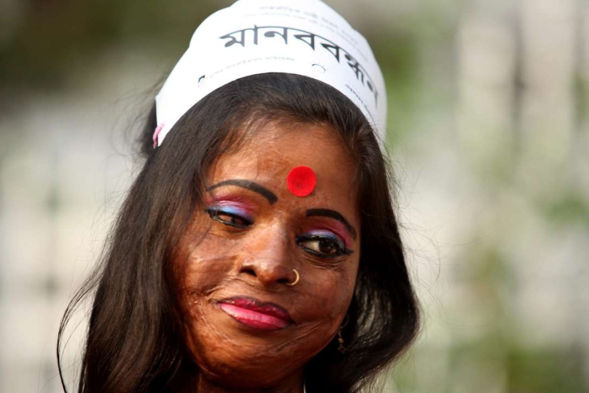 Beauty treatment: Pakistan’s acid attack survivors can smile again ...