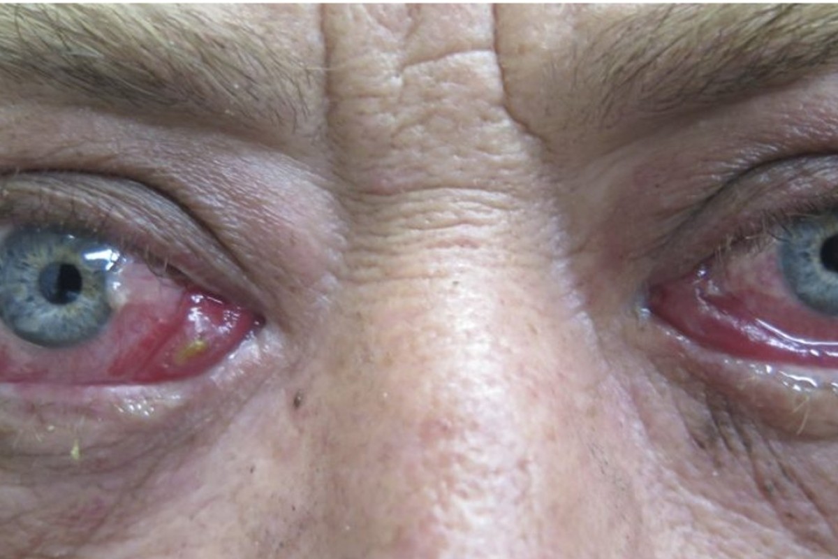 Glaucoma explained, and why regular eye checks are vital for the over ...