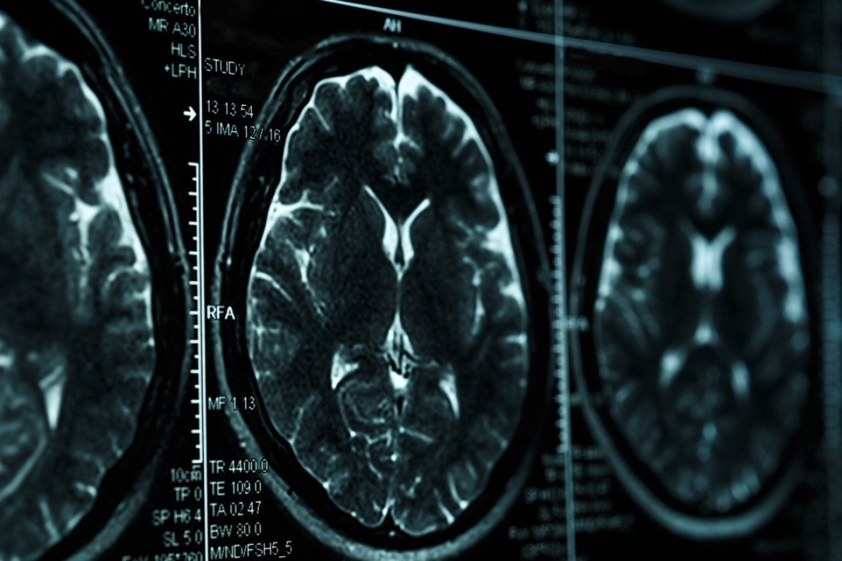 Neanderthal ancestors died out because of the shape of their brains ...