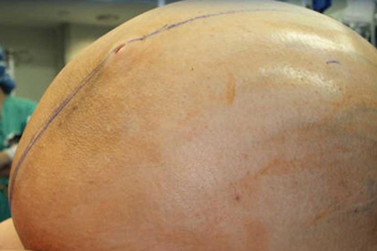 60kg tumour, removed from woman’s abdomen, had been growing at 4.5kg a ...