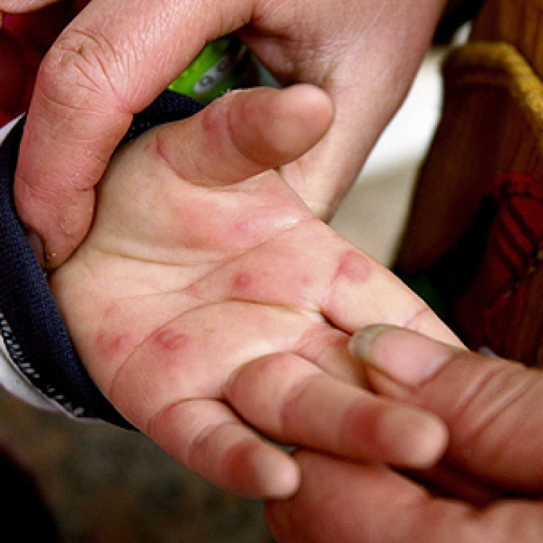 Chinese researchers find vaccine hopes for hand, foot, mouth disease ...