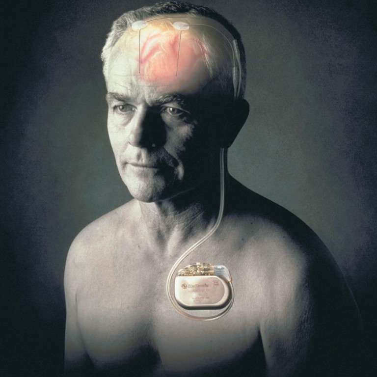 Deep brain stimulation can aid Parkinson's sufferers | South China ...