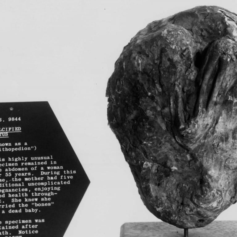 The ‘stone baby’: For more than 50 years, she carried her unborn child ...