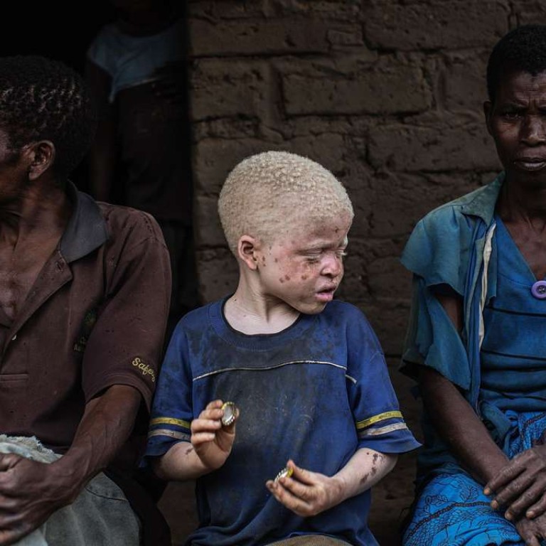 Albinos in Malawi being hunted for their body parts for witchcraft on ...
