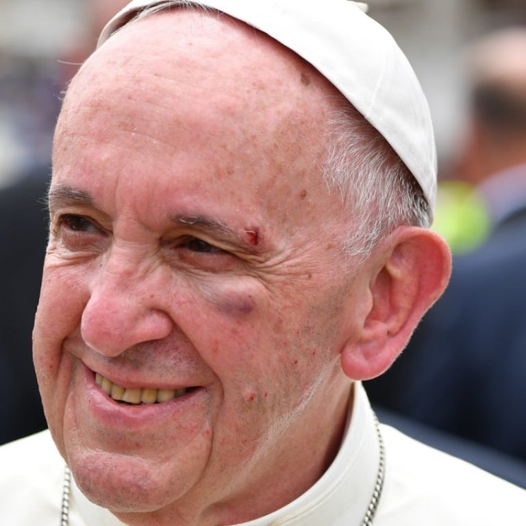 ‘I got bashed’: Popemobile jolt gives Francis a black eye | South China ...