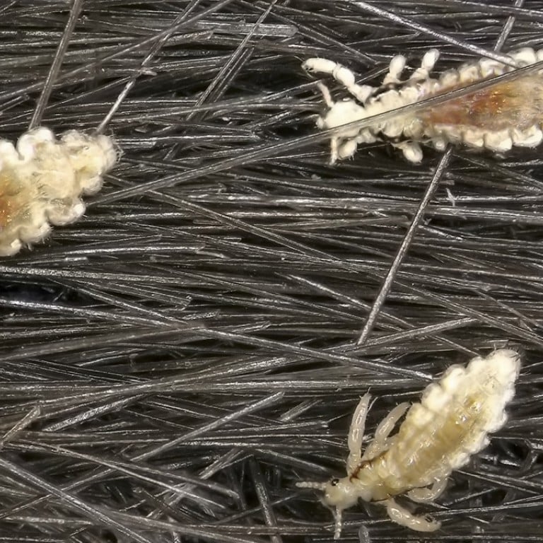 Nits: a mother’s three failed attempts to root them out, and the head ...