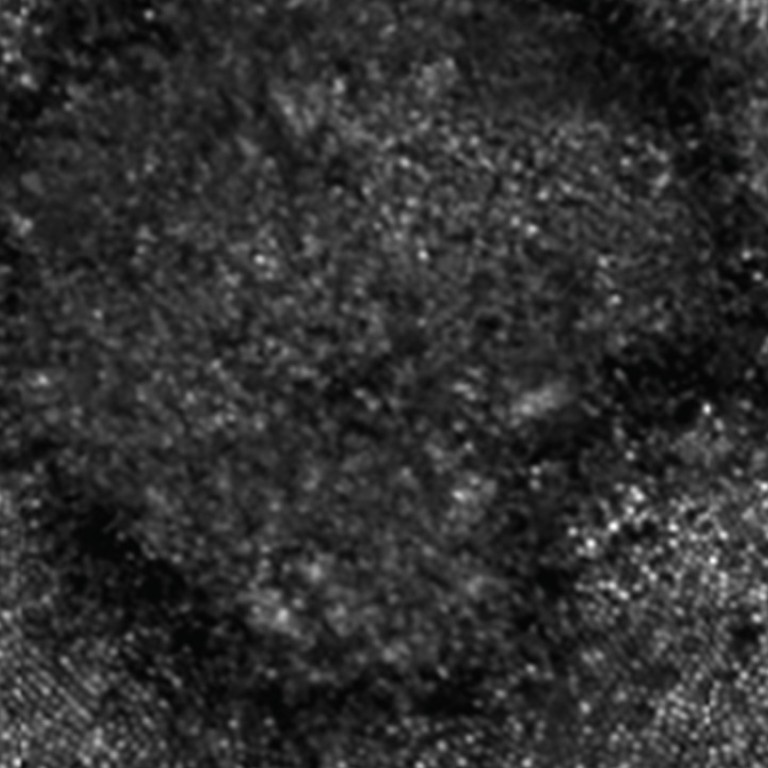 Solar eclipse was scorched on woman’s retina after she stared at sun ...