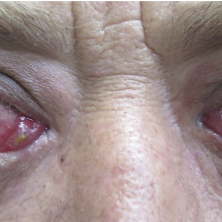 Glaucoma explained, and why regular eye checks are vital for the over ...