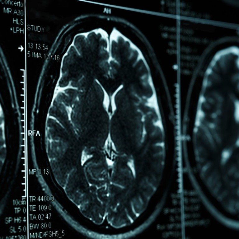 Neanderthal ancestors died out because of the shape of their brains ...