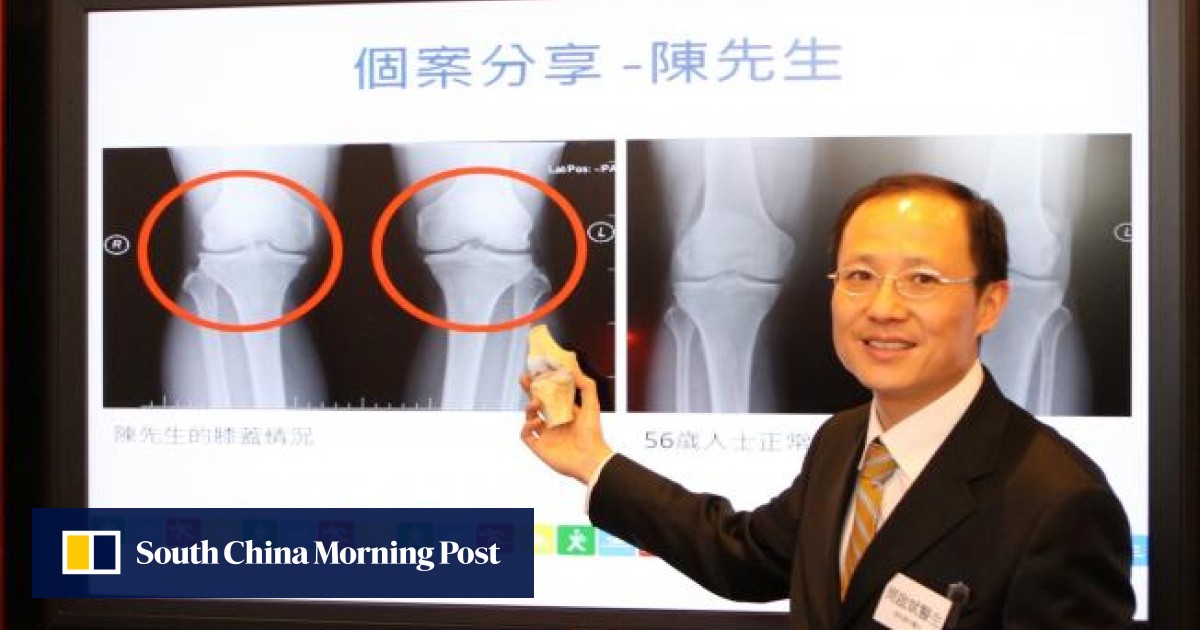 ‘Weekend athletes’ face greater arthritis risk, says orthopedic surgeon ...