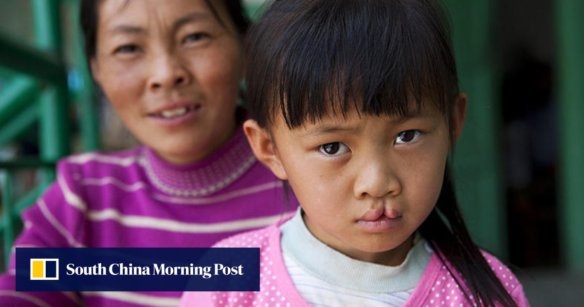 Operation Smile helps cleft lip kids in rural China | South China ...