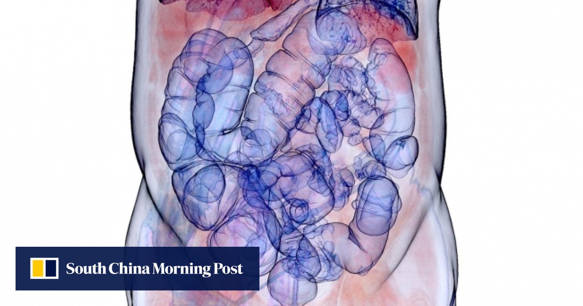 Early Screenings Can Help Prevent Colon Cancer South China Morning Post