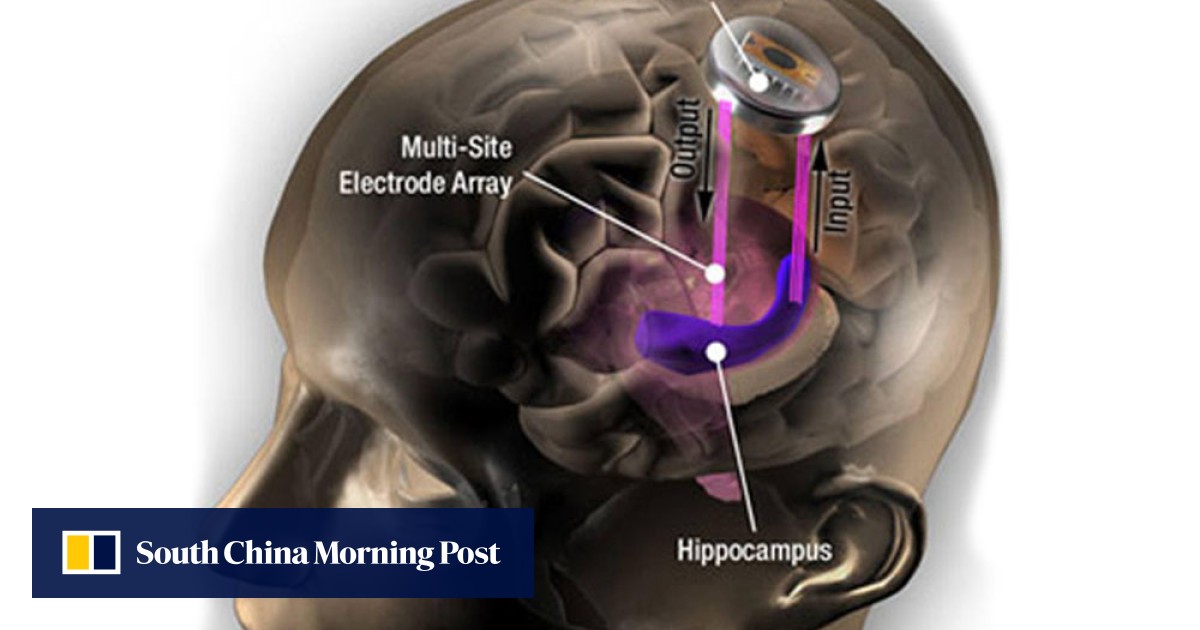 US$40m towards brain implant that could restore soldiers' memories ...