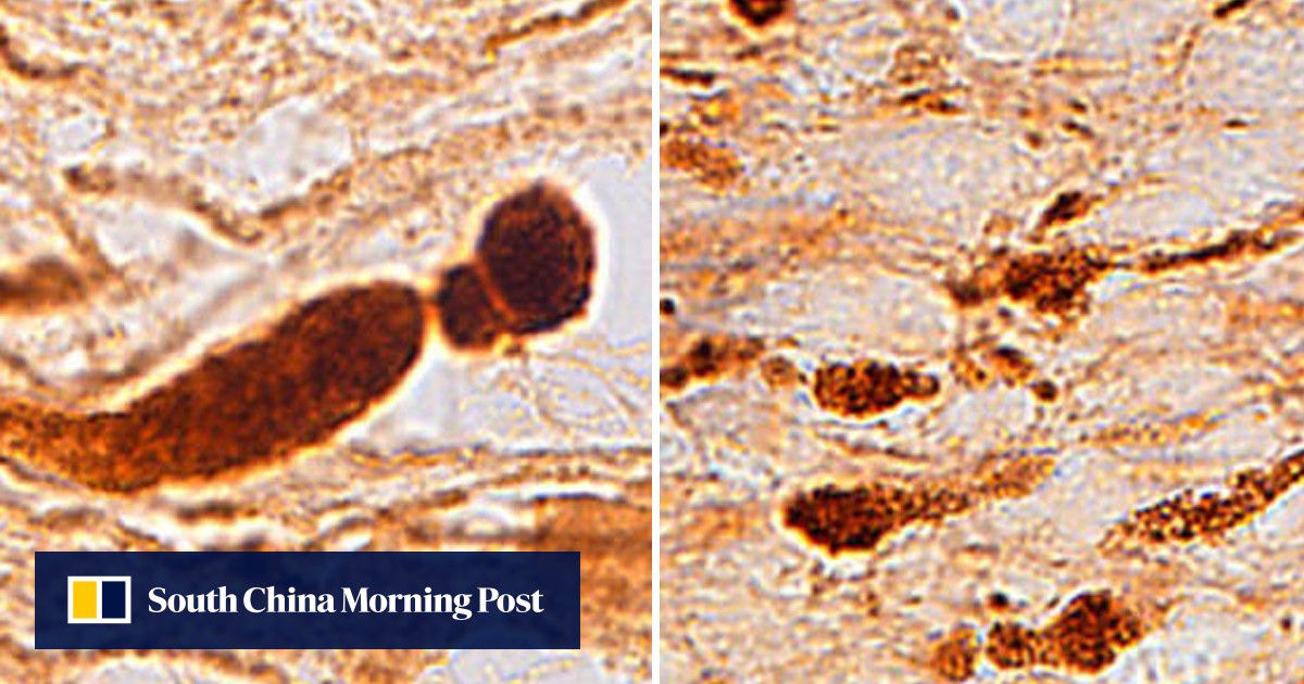 What a brain injury looks like: scientists examine blast victims ...