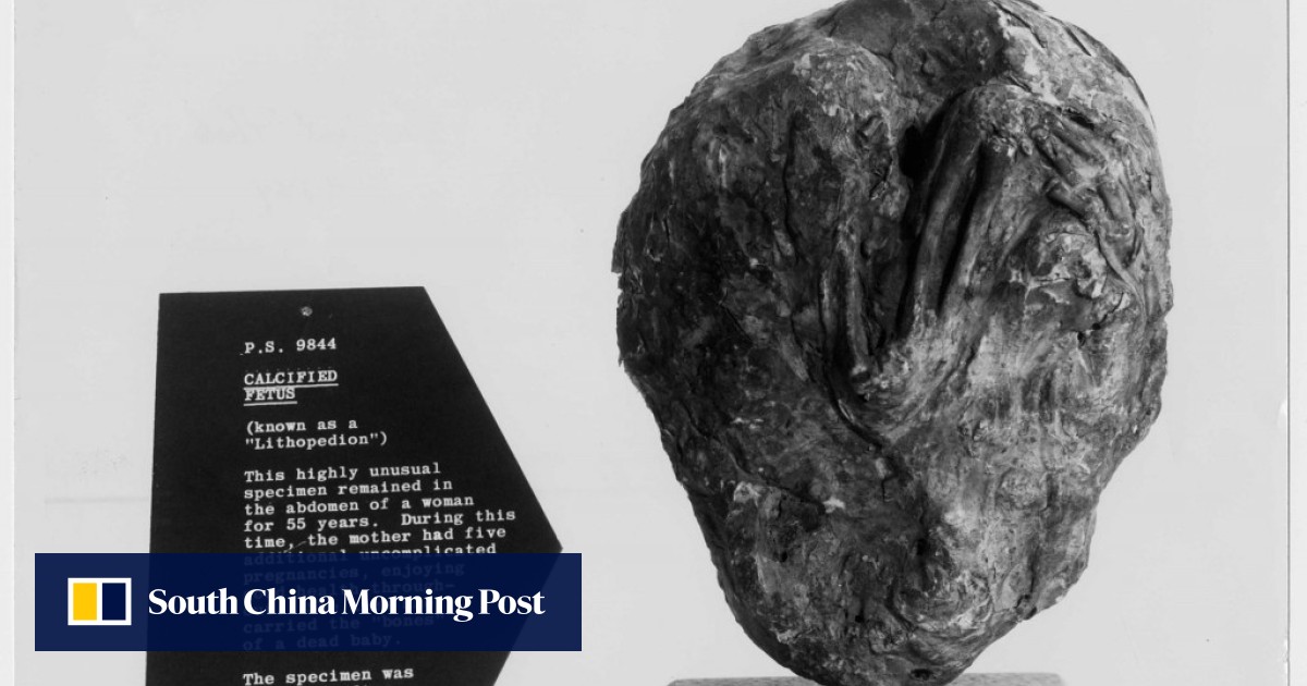 The ‘stone baby’: For more than 50 years, she carried her unborn child ...