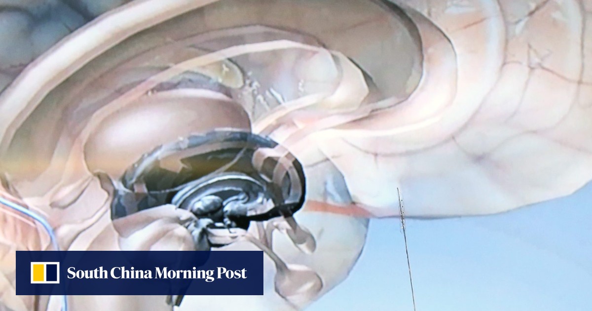 Australian scientists present ‘bionic spinal cord’ designed to help ...