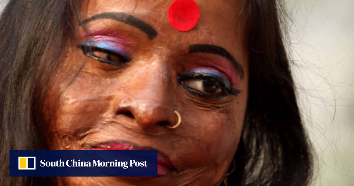 Beauty treatment: Pakistan’s acid attack survivors can smile again ...