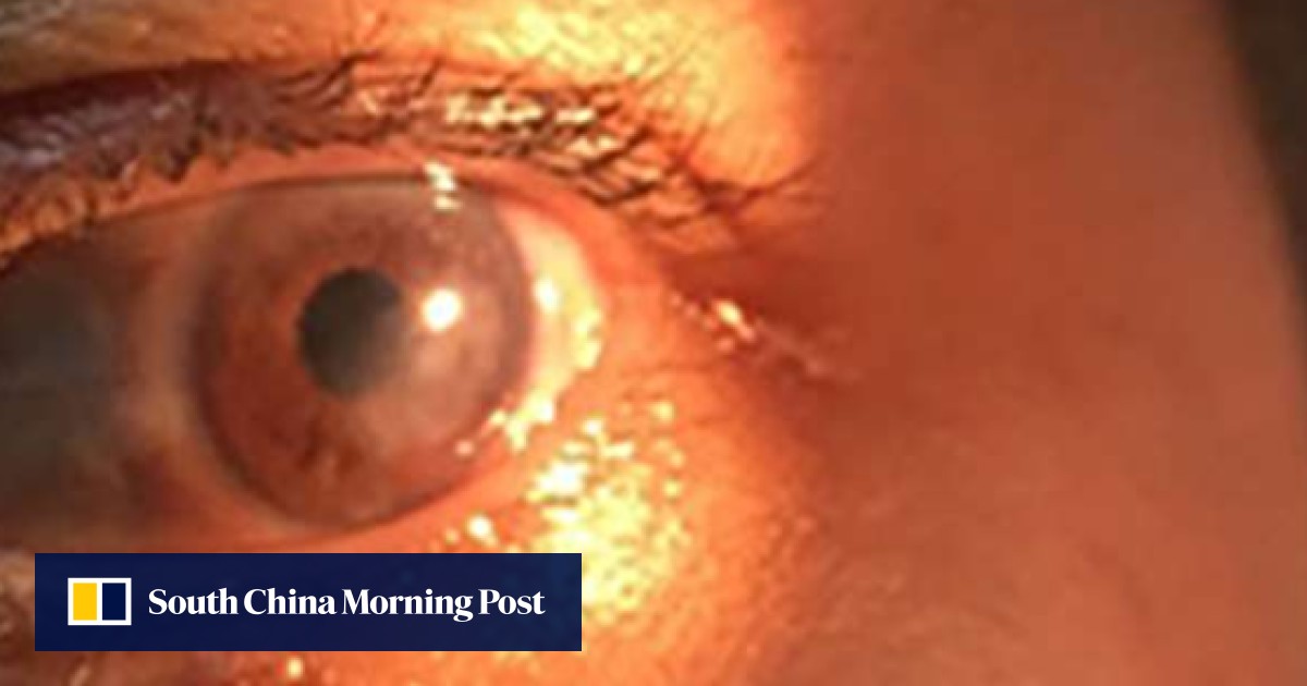 Chinese woman expected to regain eyesight after transplant using pig’s ...