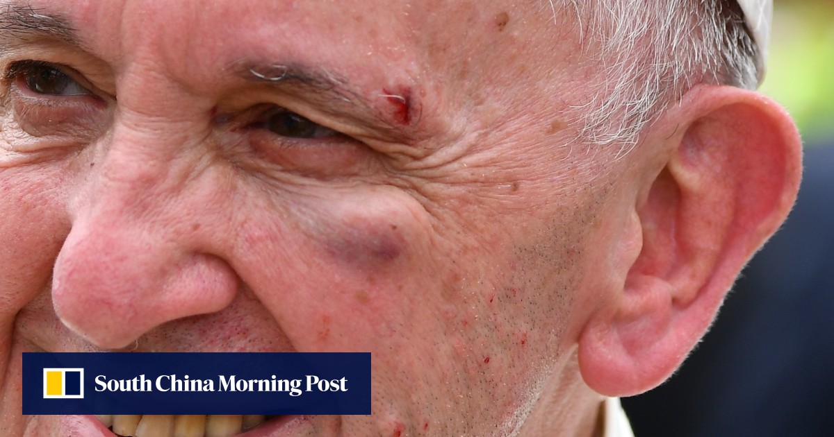 ‘I got bashed’: Popemobile jolt gives Francis a black eye | South China ...