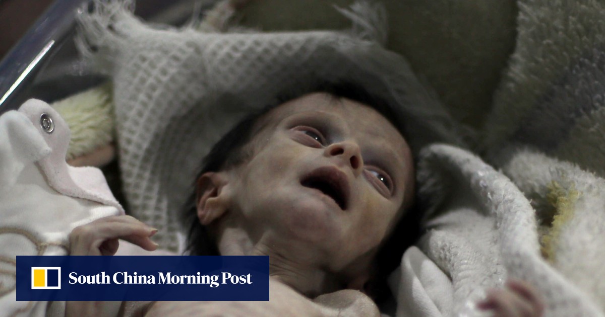 Heartbreaking images of starving Syrian baby Sahar, close to death ...