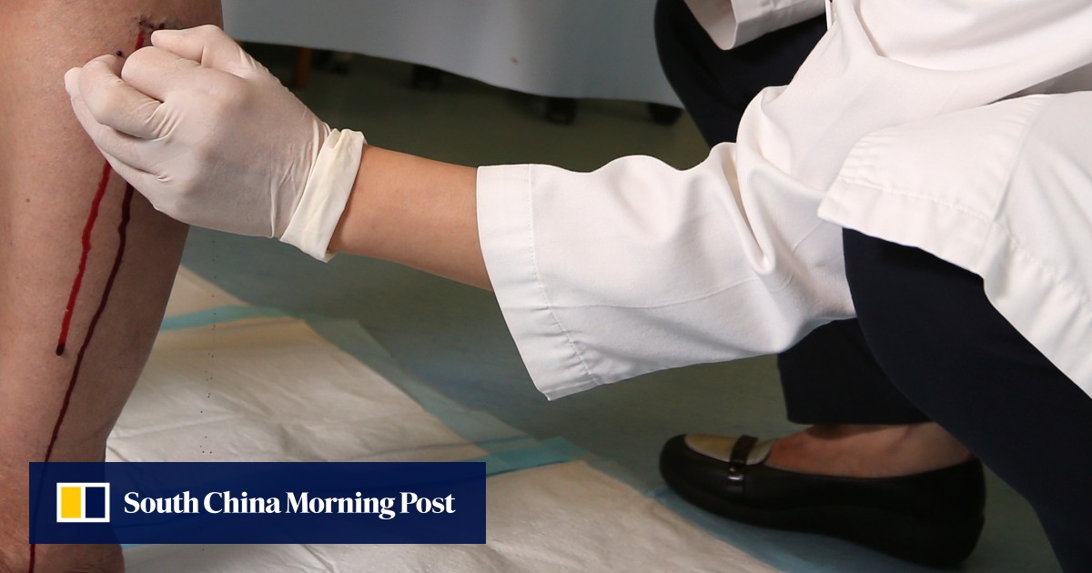 Varicose veins: bloodletting vs keyhole surgery – how Chinese and ...