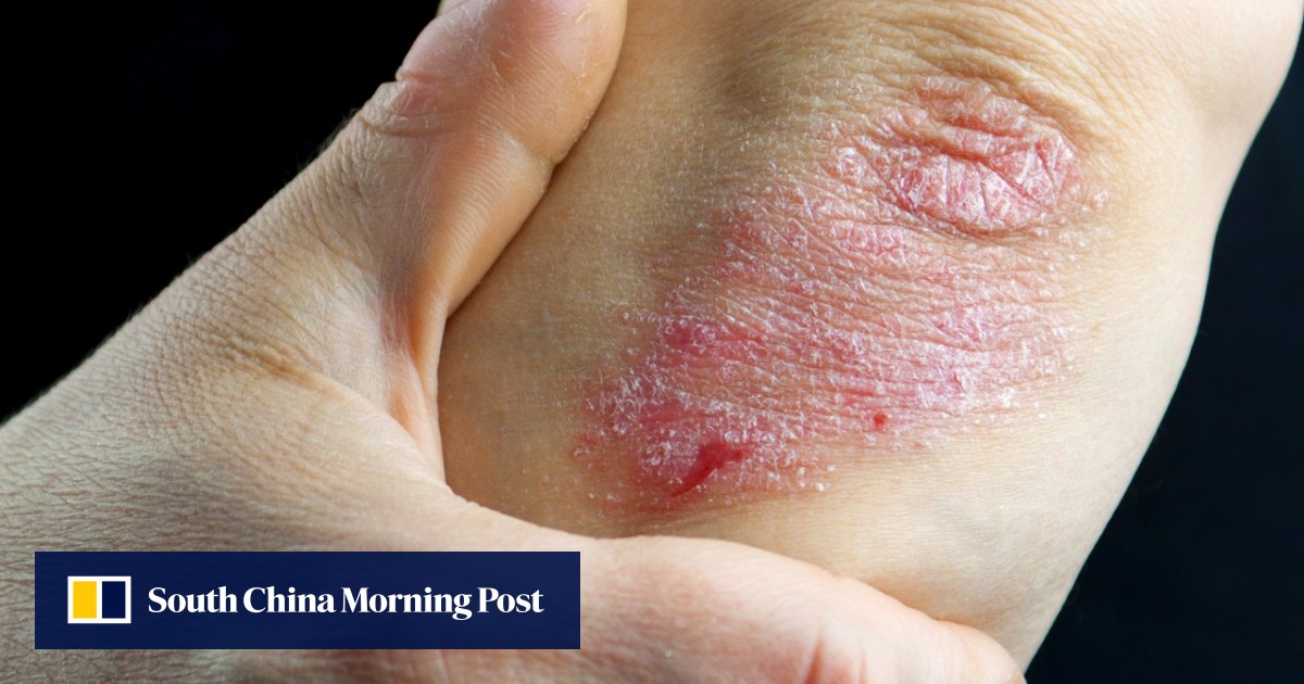 Psoriasis patients in Hong Kong seek quicker access to better treatment ...